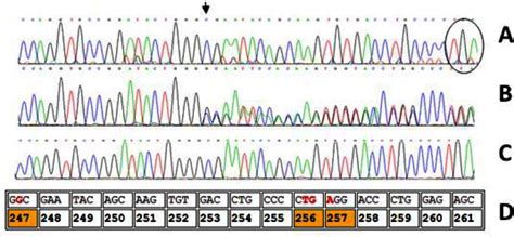 New Single Nucleotide Deletion In The Smpd1 Gene Causes Niemann Pick