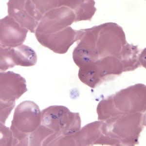 Babesiosis