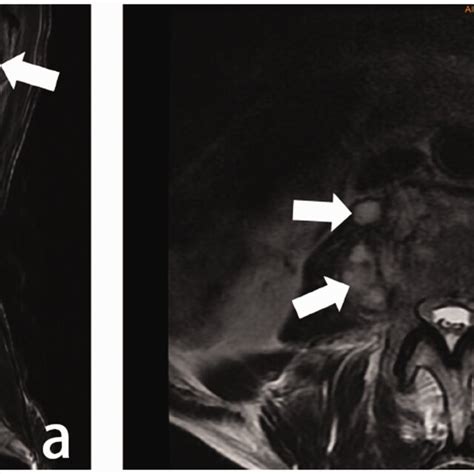 A Magnetic Resonance Image Of A Patient With Diffuse Edema In The