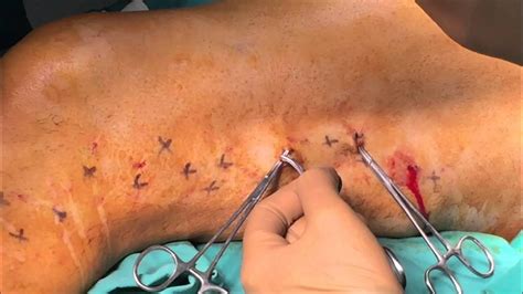 Mini Phlebectomy For Varicose Vein Sutureless Varicose Operation Youtube