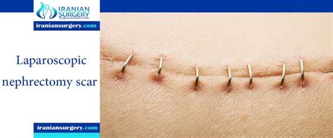 Laparoscopic Nephrectomy Scar Iranian Surgery