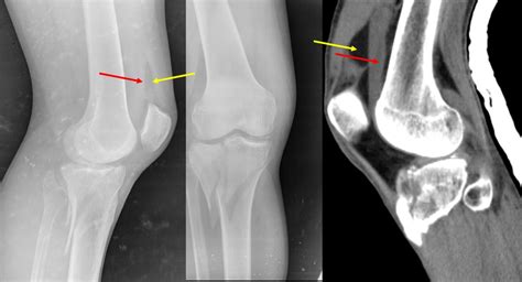 Fatfluid Leveling In Acute Knee Trauma A Critical Red Flag For Intra