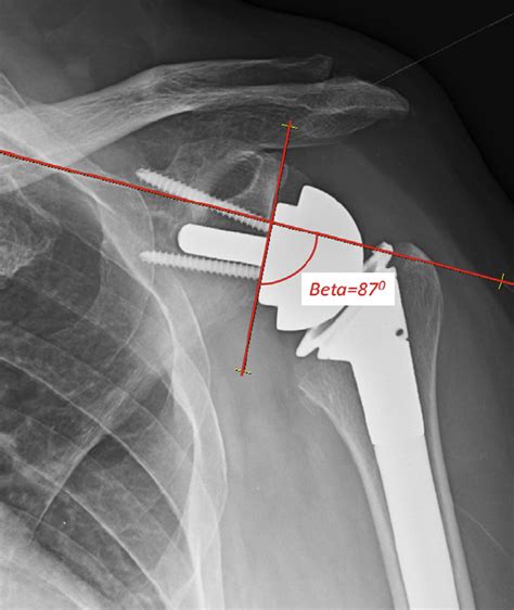 Uw Shoulder And Elbow Academy Dislocation In The Reverse Total