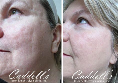 Fractional Laser Resurfacing Artofit