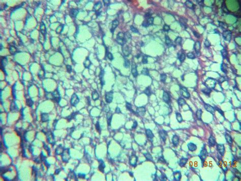 Baraniddrcsrl 43 F Breast Mass Excision Clinical Diagnosis Giant