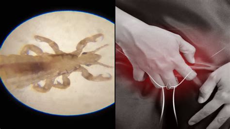 Women With Crabs Disease