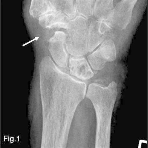 Preoperative X Ray Of The Wrist Revealing Widening And Erosion Of The