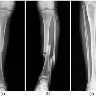 PDF Analysis On Leg Bone Fracture Detection And Classification Using X Ray Images