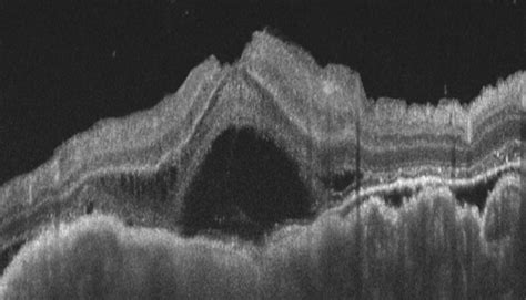 Bacillary Layer Detachment In Retina Eyewiki