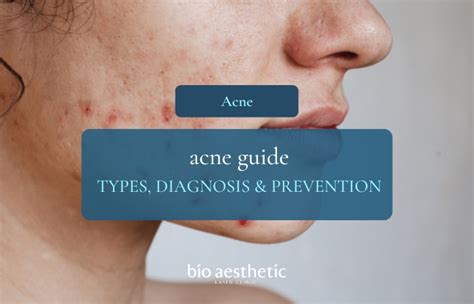 Acne Treatment Types Diagnosis And Prevention
