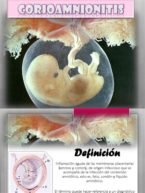 Corioamnionitis Final Pdf Leucocito Salud Maternal
