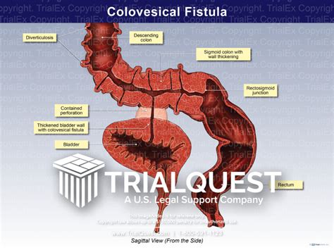 Colovesical Fistula Trialexhibits Inc