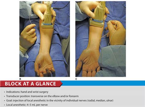 Forearm Nerve Block Blocks Carpal Tunnel Clinic Gold Coast
