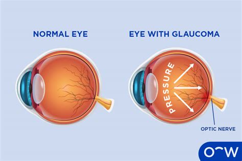 Optic Nerve Glaucoma Advanced Blindness What Is Usually The First Sign