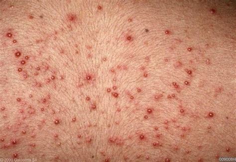 Otorrinoweb AcnÉ Esteroideo