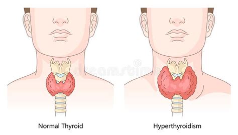 Normal Thyroid And Hyperthyroidism Diagram Medical Stock Vector