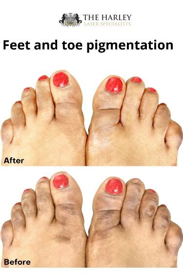 Feet And Toe Pigmentation Pigmentation Treatment Dark Skin Tone