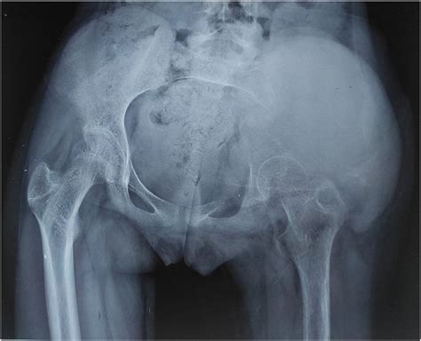 Plain Radiograph Of Pelvis With Bilateral Hip Showing Lytic Destructive