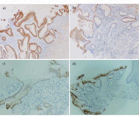 Figure 5 From Heterotopic Gastric Mucosal Patch Of The Proximal Esophagus Semantic Scholar