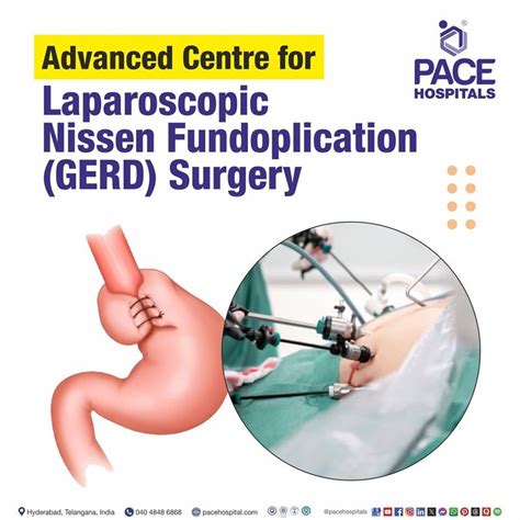 Best Laparoscopic Fundoplication Surgery In Hyderabad India
