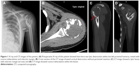Low Grade Central Osteosarcoma In Proximal Humerus A Rare Entity Ott