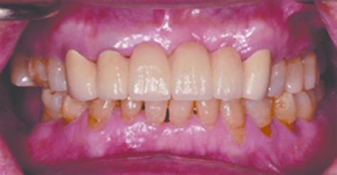 Intraoral Frontal View At Maximum Intercuspal Position After