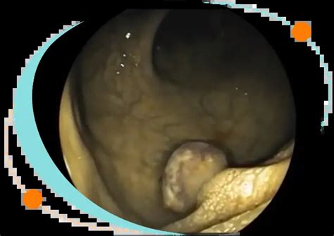 Colonoscopic Polypectomy In Bangladesh