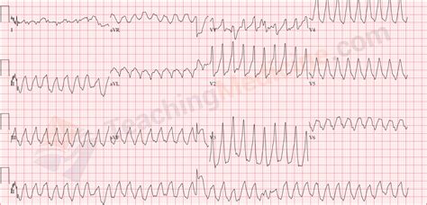 Monomorphic Ventricular Tachycardia Also Known As Vt