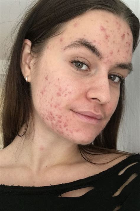 Life After Accutane 9 Women On What Really Happens When The Dosing