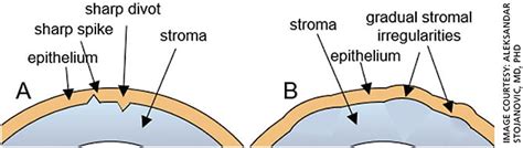 The Rise Of Epithelial Thickness Mapping Ophthalmology Management