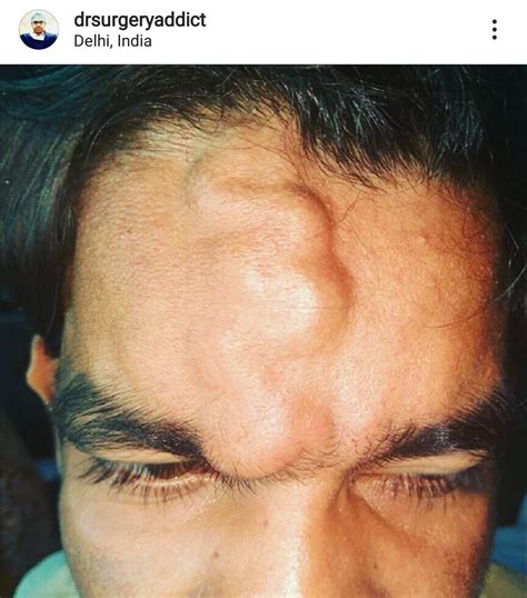 Drsurgeryaddict ⚕️cirsoid Aneurysm These Are Rare