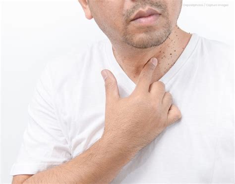 Queratosis ¿qué Es Y Cómo Afecta