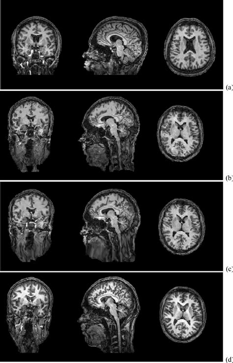 nonrigid matching of mr images from two different individuals a