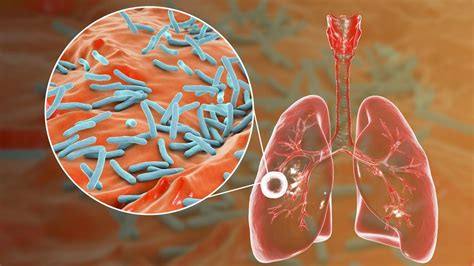 La Tuberculosis Extremadamente Resistente Xdr Tb Un Desafío Global Para La Salud Todos