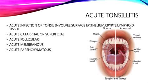 Adenoidsacute And Chronic Tonsillitis Pptx