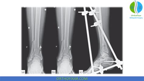 Pilon Fracture Tibial Plafond Fracture Orthofixar