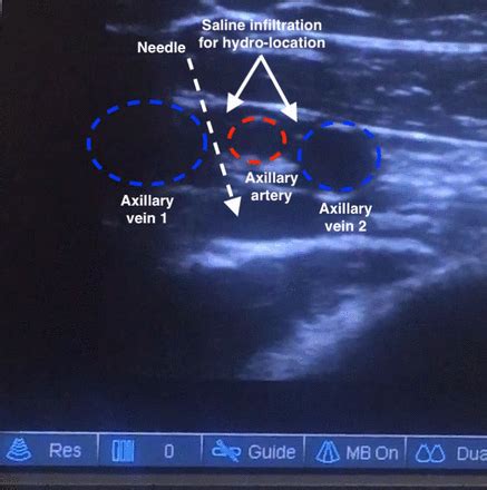 Double Axillary Vein Variation Diagnosed With Ultrasound Guidance