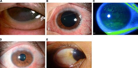 Vernal Conjunctivitis Causes Symptoms Diagnosis Treatment And Prognosis