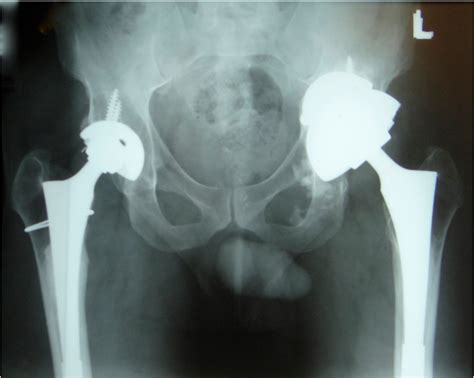 Figure 1 From The Use Of Augment Devices In Revision Acetabular Surgery