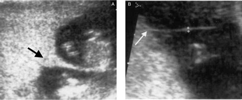 First Trimester Ultrasound Image Of A Fused Dichorionic Placenta With