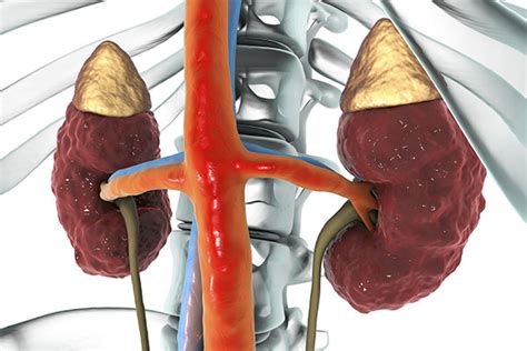 Adrenal Gland Vein Sampling Atlanta Vascular And Vein Center