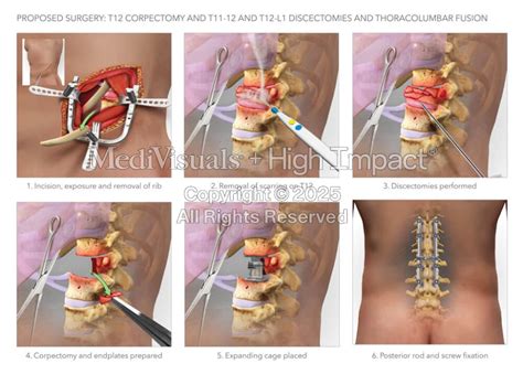 Corpectomy Discectomies Fusion Medivisuals High Impact