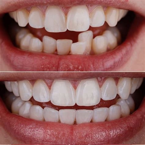 Crooked Teeth Causes Impact And Treatment