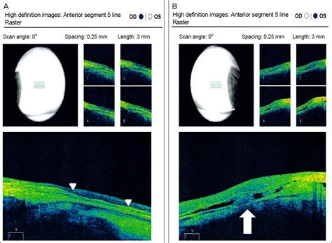 Senile Scleral Plaque