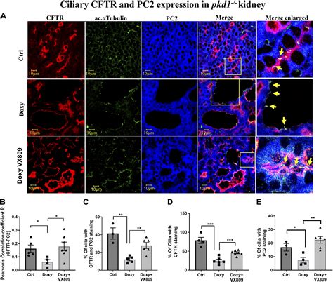 Cftr And Pc2 Partners In The Primary Cilia In Autosomal Dominant