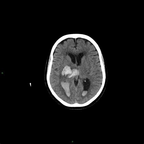 Thalamic Hemorrhage Prognosis At Malik Keck Blog