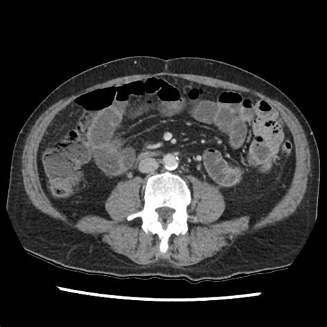 Cholangiocarcinoma Hilar Type Radiopaedia 59780 67205 A Nc Commons Cholangiocarcinoma Hilar Type Radiopaedia 59780 67205 A Nc Commons