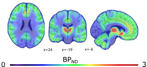 Neuroimaging Study Reveals Brain Opioid Release During Sex Åbo Akademi