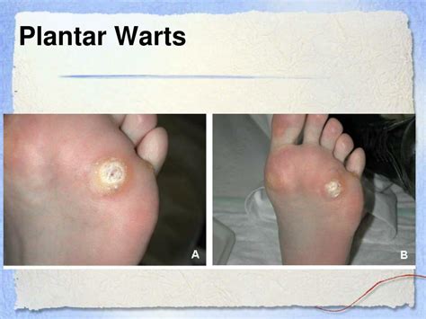 Ppt Chapter 34 Warts Revised 8 15 10 Powerpoint Presentation Free