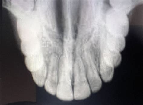 Radiology Occlusal Technique Flashcards Quizlet